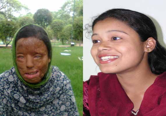 Acid Attack Victims Before And After A Corrosive Love: Living With The